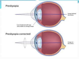 refractive error.ppt definition. Introduction. Etiology | PPT
