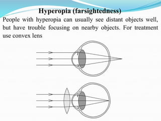 refractive error.ppt definition. Introduction. Etiology | PPT