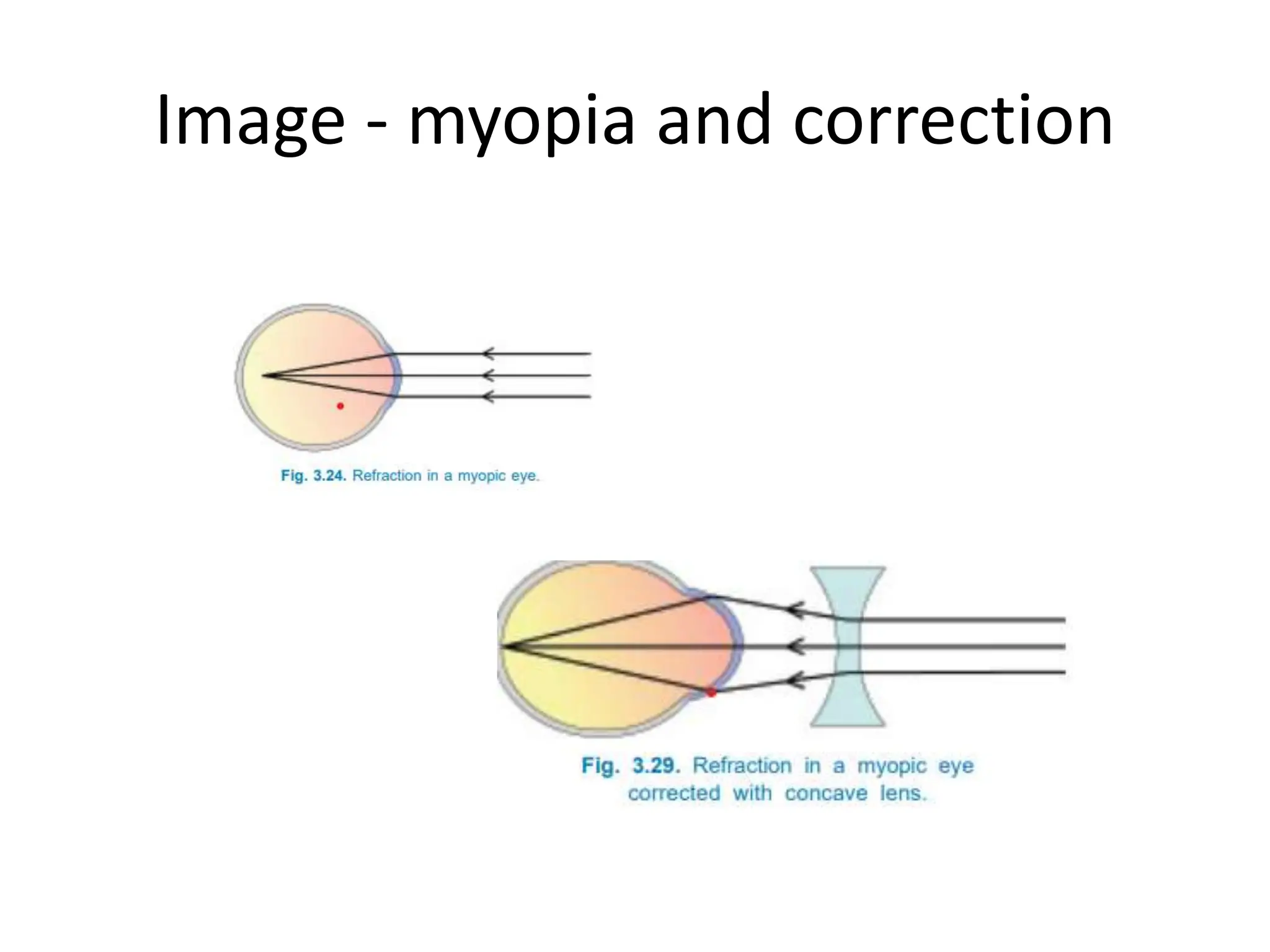 Refractive error-Myopia, by dr.jyoti pankaj.pptx