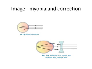 Refractive error-Myopia, by dr.jyoti pankaj.pptx