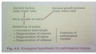 Refractive error (Myopia )by Upendra pal .pdf