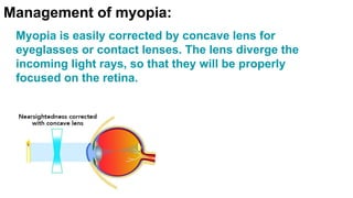 Refractive error (Myopia )by Upendra pal .pdf