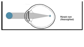 Refractive error (Myopia )by Upendra pal .pdf