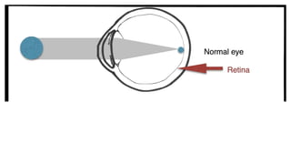 Refractive error (Myopia )by Upendra pal .pdf