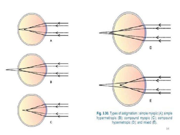 phthalmology.Refractive errors.(dr.ali)
