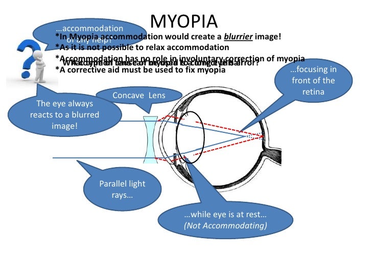 Refractive Errors
