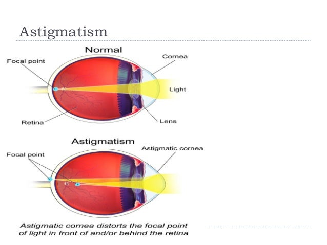 Refractive errors