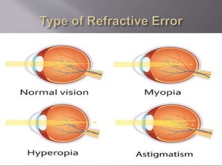 Refractive error's | PPTX