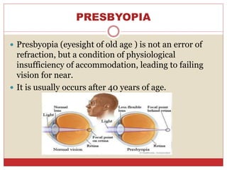 Refractive errors (eye condions) | PPTX