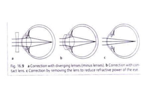 Refractive errors | PPTX