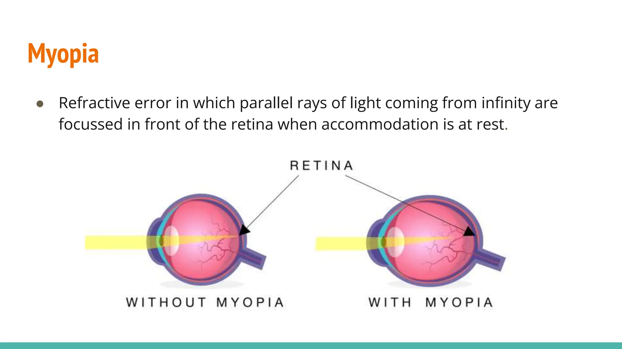 REFRACTIVE ERRORS and its management (2).pptx