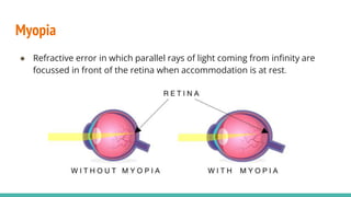 REFRACTIVE ERRORS and its management (2).pptx
