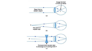 REFRACTIVE ERRORS and its management (2).pptx