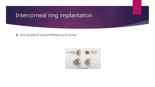 Refractive errors of eye ophthalmology astigmatism hypermetropia myopia ...