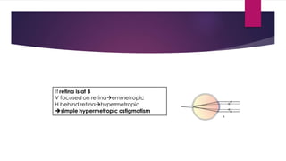 Refractive errors of eye ophthalmology astigmatism hypermetropia myopia ...