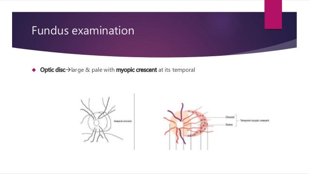Refractive errors of eye ophthalmology astigmatism hypermetropia myop…