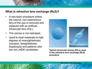 Refractive lens exchange 2017 | PPT