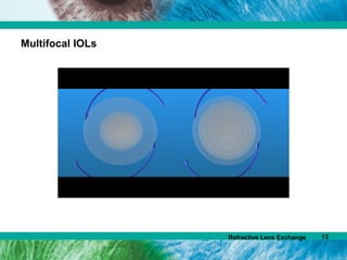 Refractive lens exchange 2017 | PPT