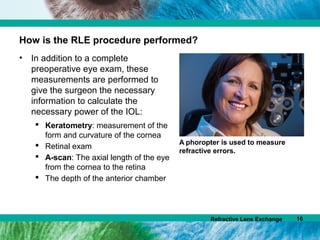 Refractive lens exchange 2017 | PPT