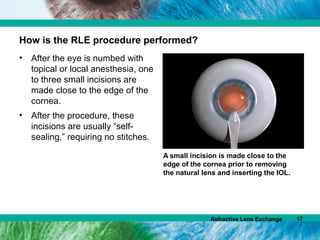 Refractive lens exchange 2017 | PPT
