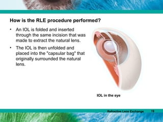 Refractive lens exchange 2017 | PPT