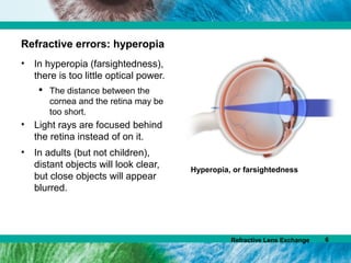 Refractive lens exchange 2017 | ODP