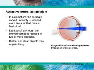 Refractive lens exchange 2017 | ODP