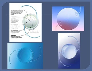 REFRACTIVE LENS EXCHANGE(CLEAR LENS EXTRACTION).pptx by sudhakar.pptx