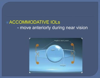 REFRACTIVE LENS EXCHANGE(CLEAR LENS EXTRACTION).pptx by sudhakar.pptx