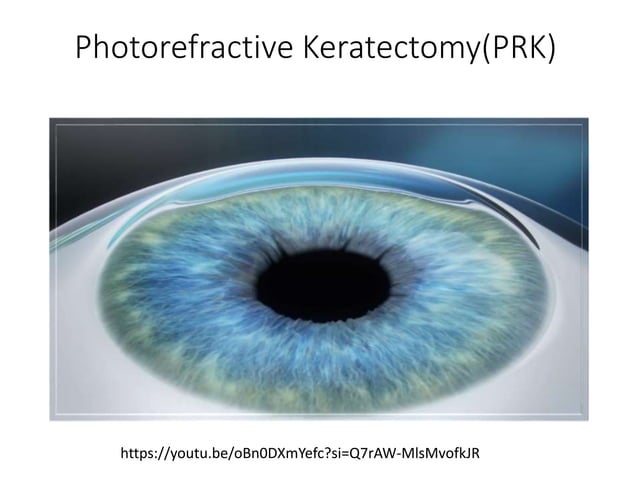 Refractive Surgery- Principle, Selection of eyes, Instruments ...