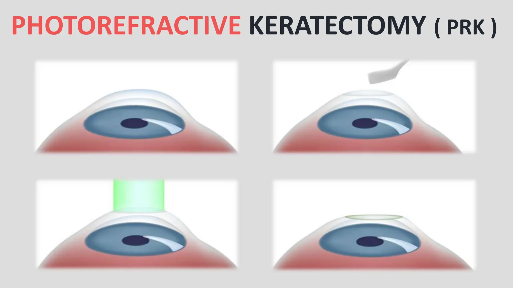 REFRACTIVE SURGERY.pptx