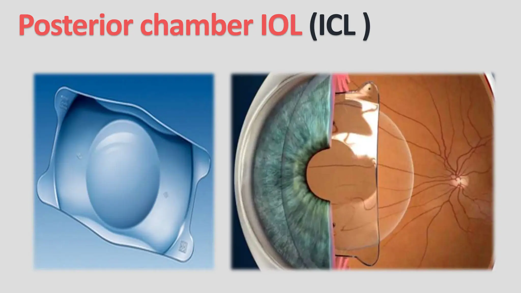 REFRACTIVE SURGERY.pptx