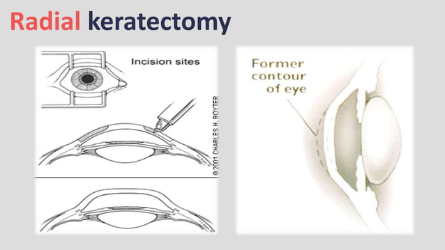 REFRACTIVE SURGERY.pptx