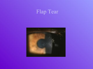 Refractive surgery basics, LASIK | PPT