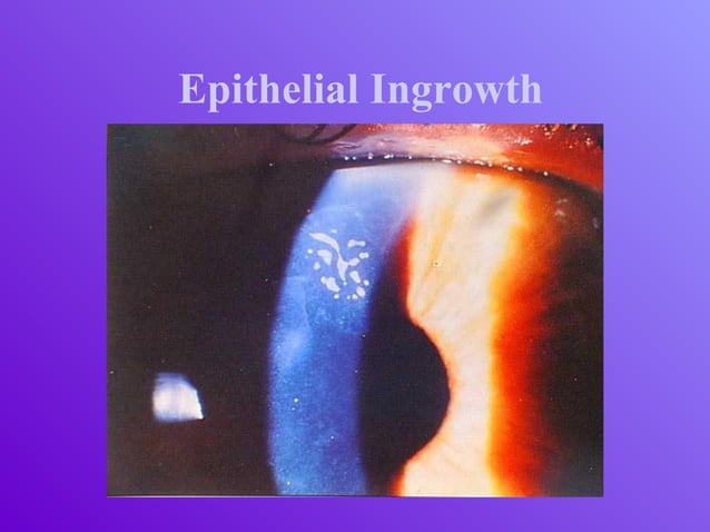 Refractive surgery basics, LASIK | PPT