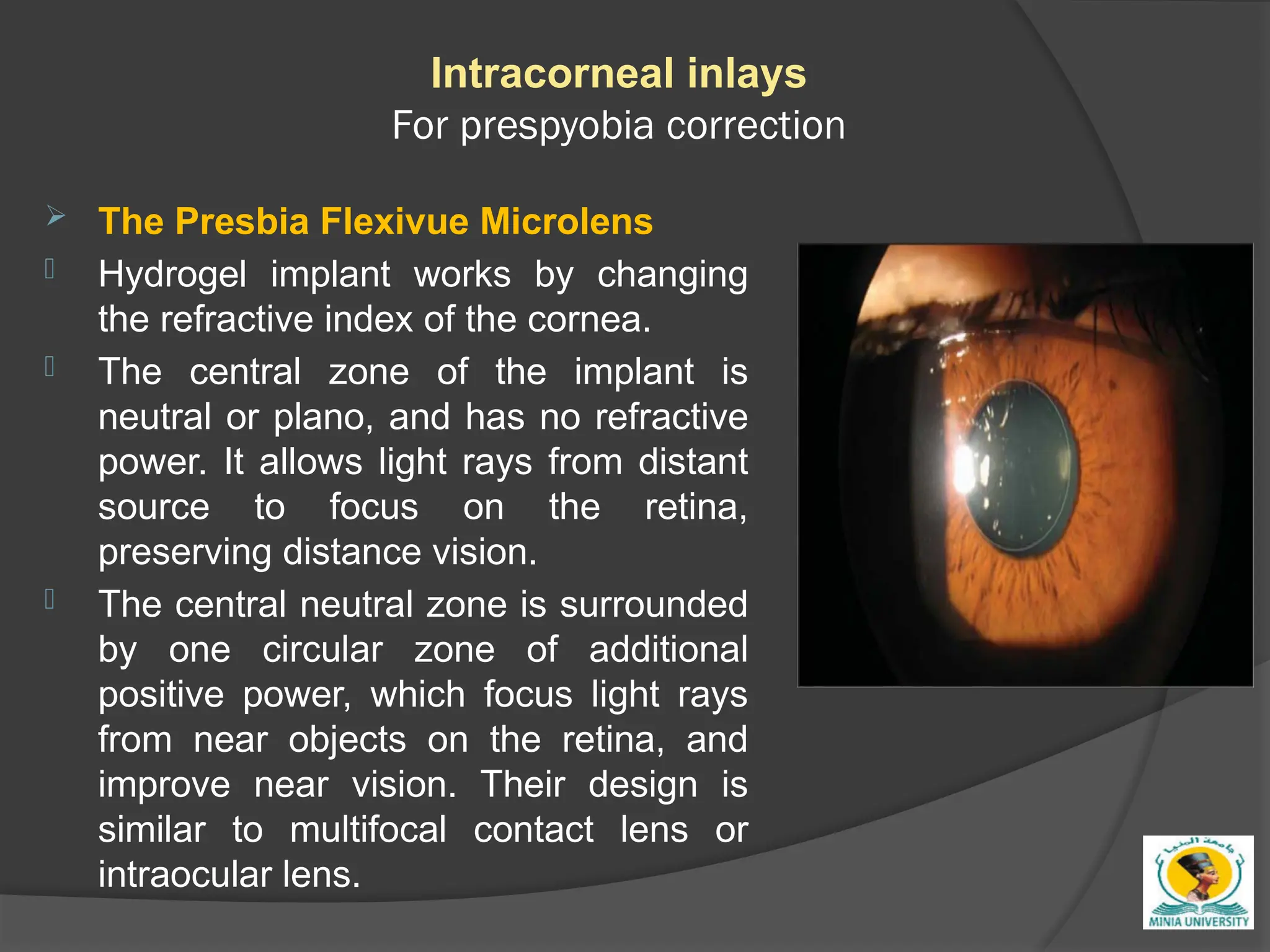 Refractive surgery for undergraduate simply | PPTX