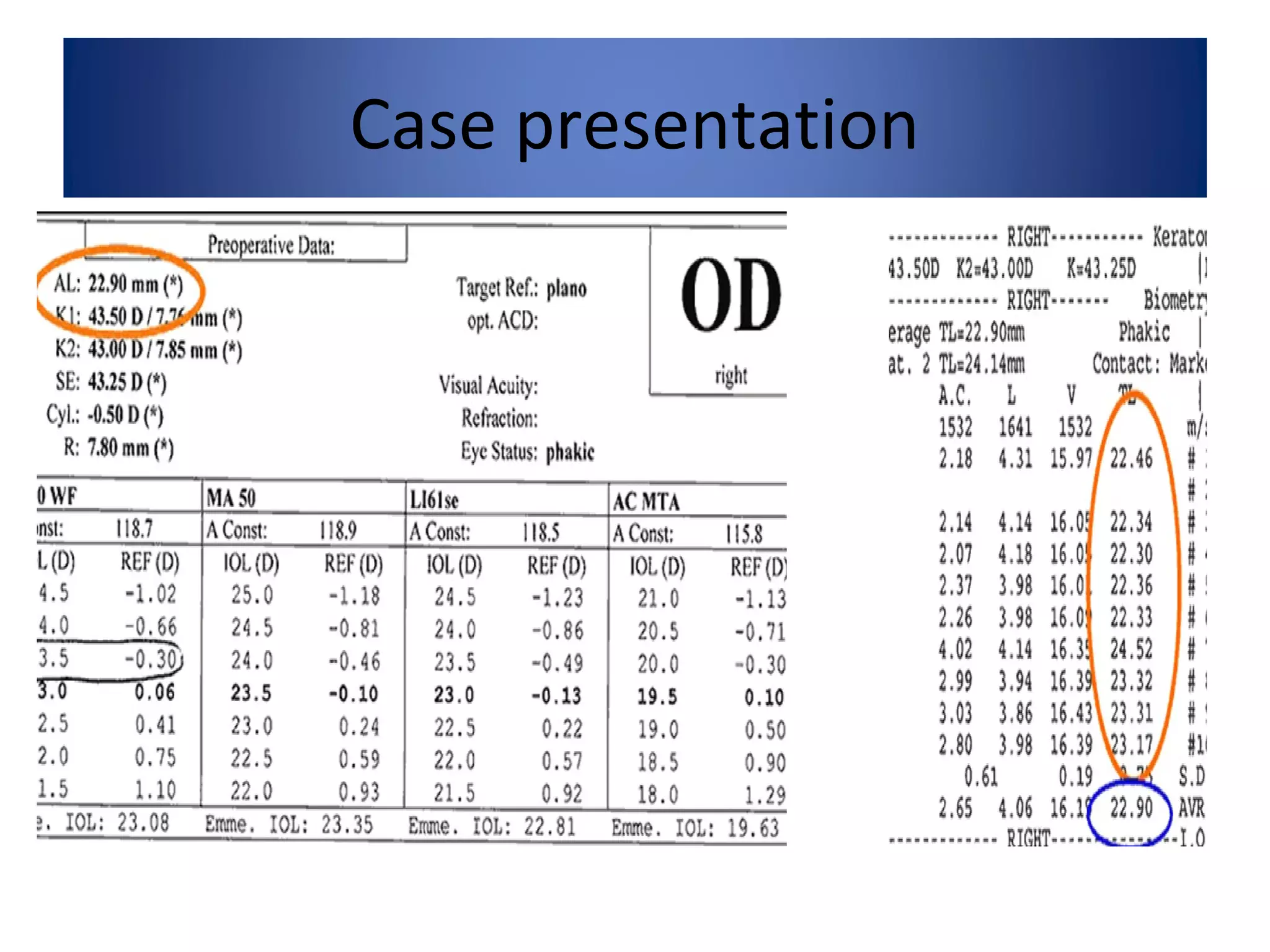 Refractive surprise | PPT