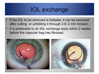 Refractive surprise | PPT