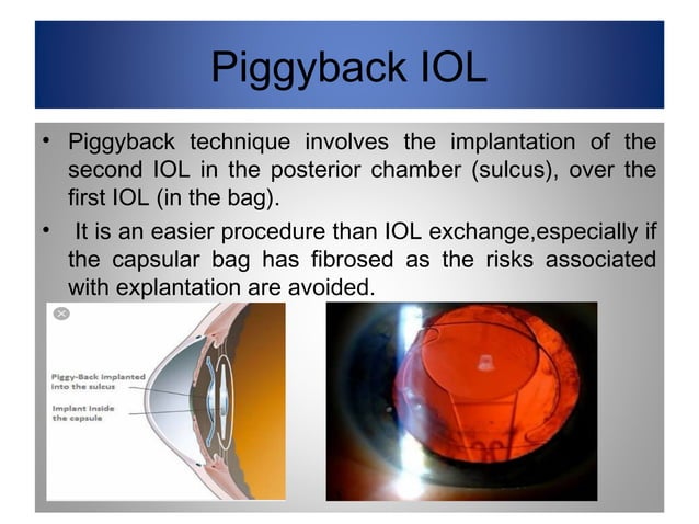 Refractive surprise | PPT