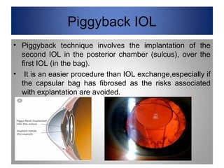 Refractive surprise | PPT