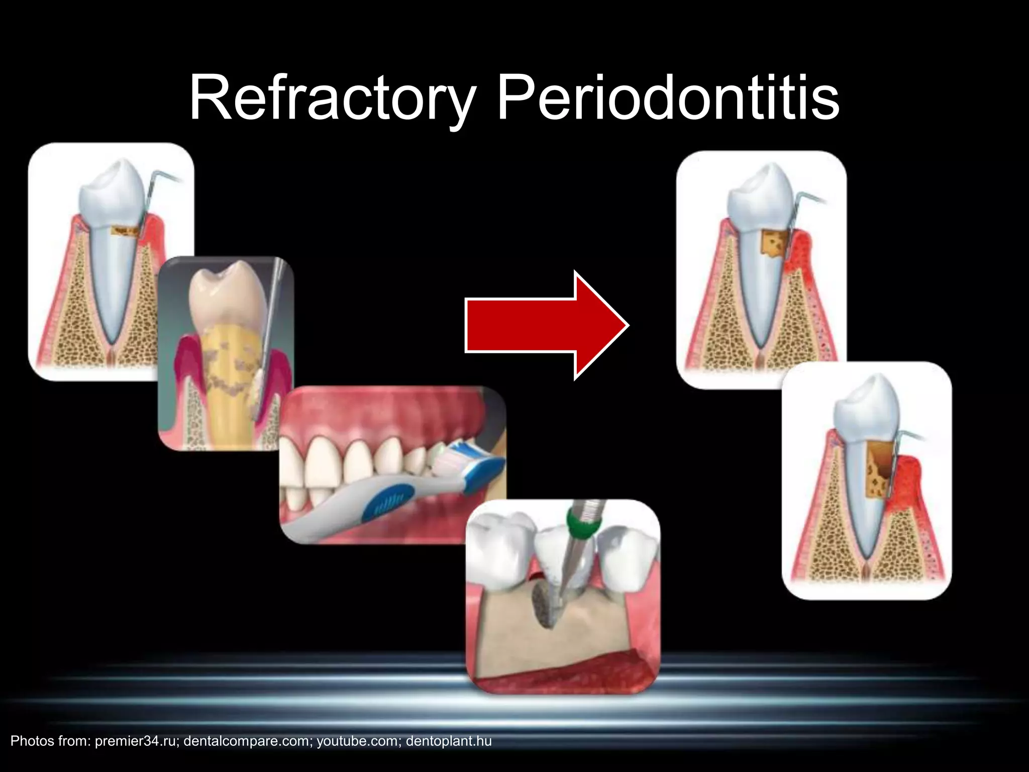 Refractory Periodontitis | PPTX