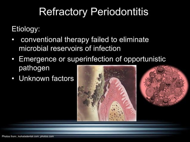 Refractory Periodontitis | PPTX