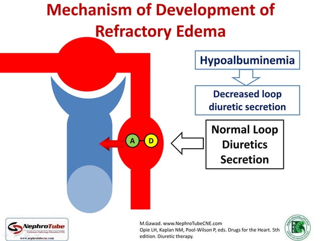 Refractory Edema with CHF - Stepwise Approaches - Nephrology ...