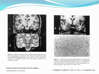 Refractory epilepsy | PPT