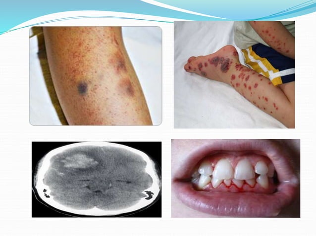 Refractory itp | PPT