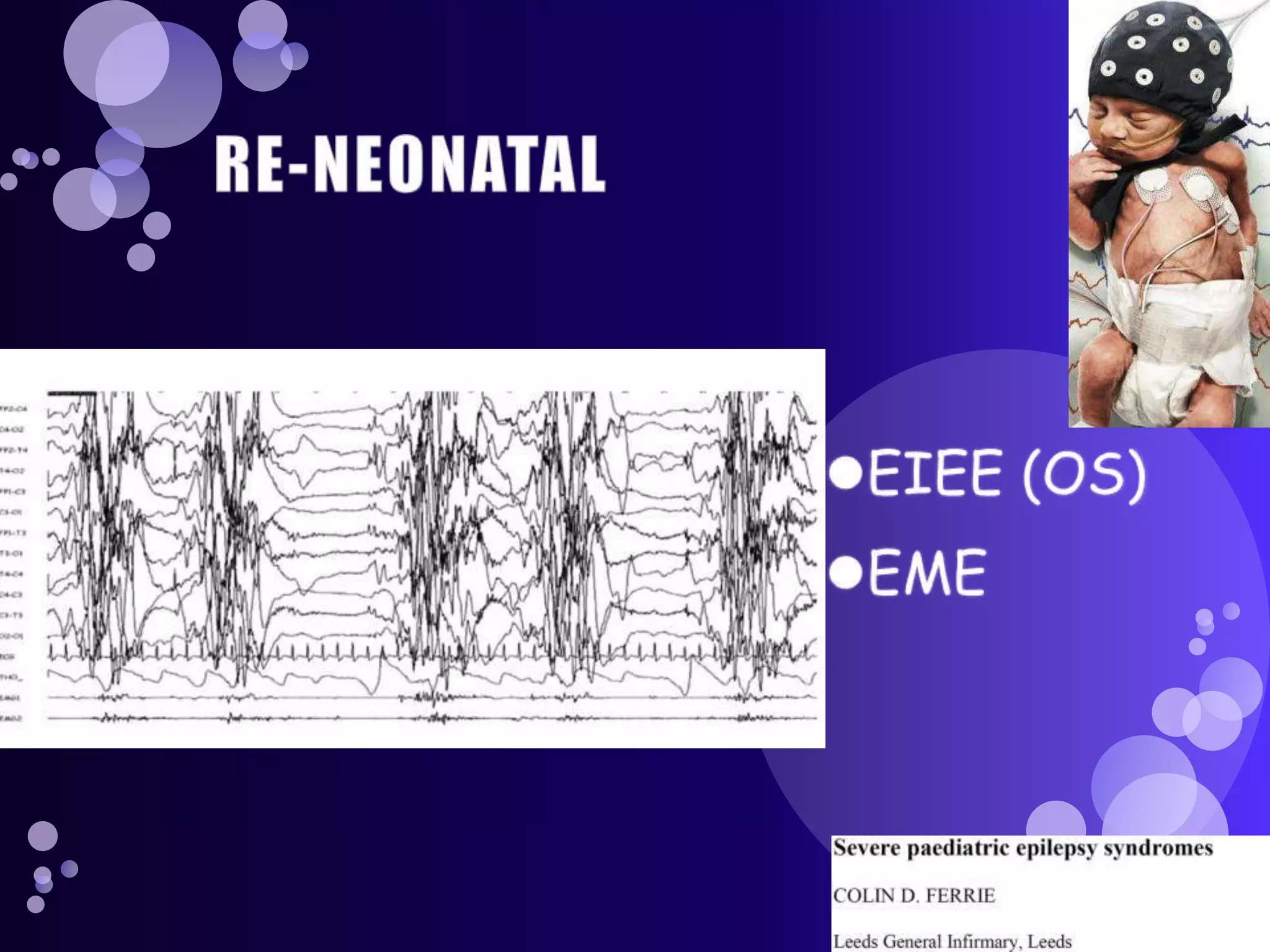 Refractory pediatric epilepsy ,Management | PPTX