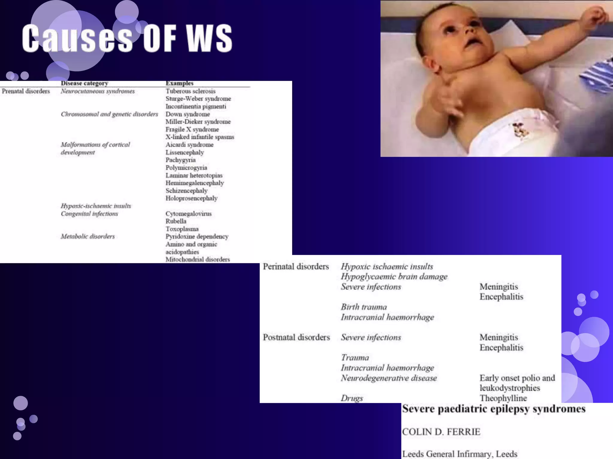 Refractory pediatric epilepsy ,Management | PPTX