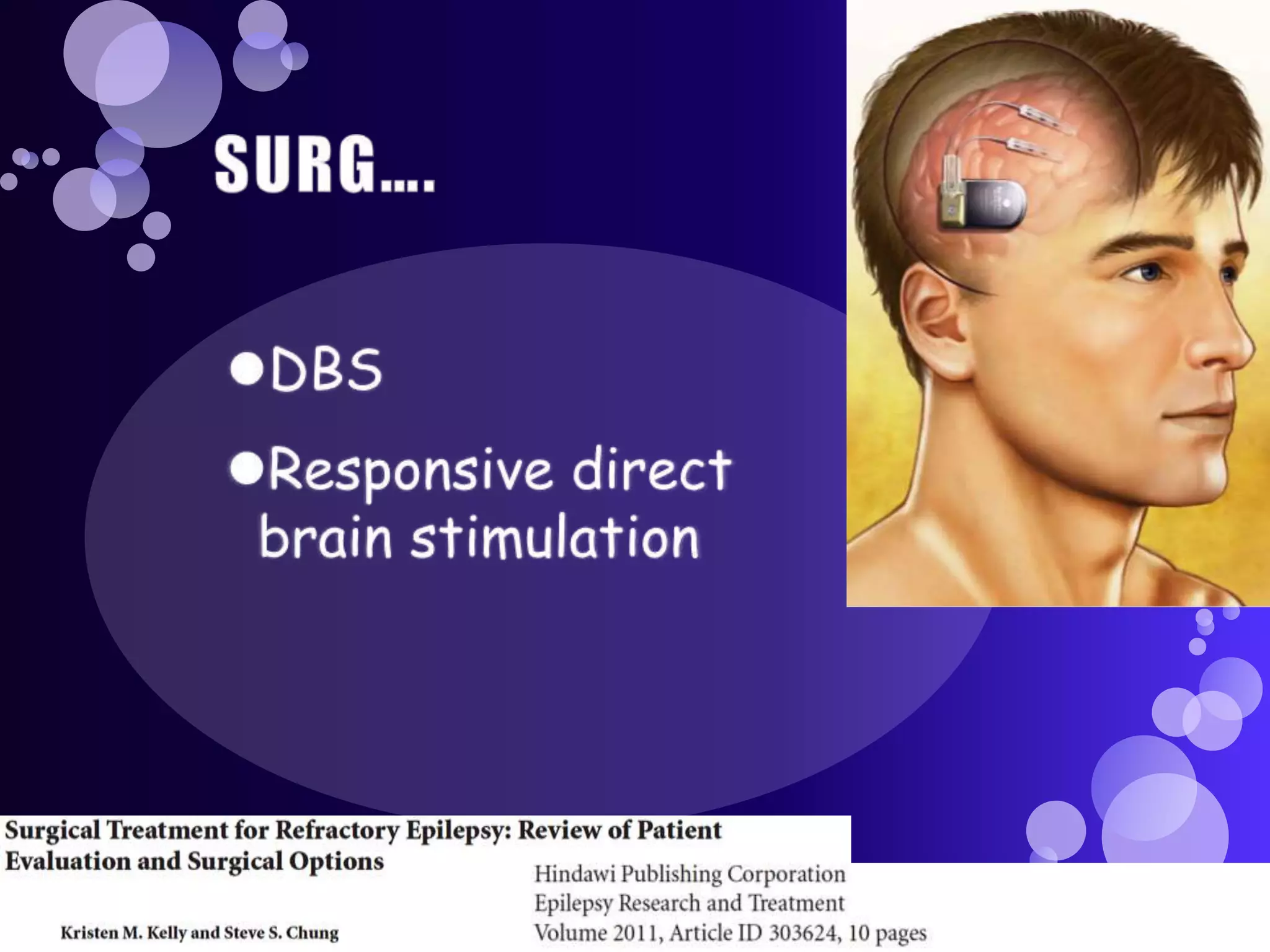 Refractory pediatric epilepsy ,Management | PPTX