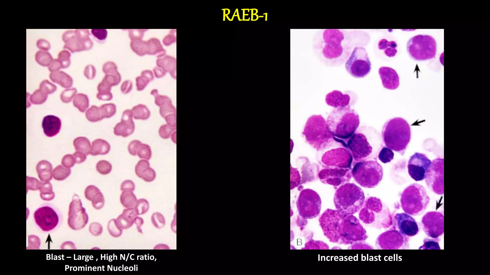 Refreactory anemia | PPTX