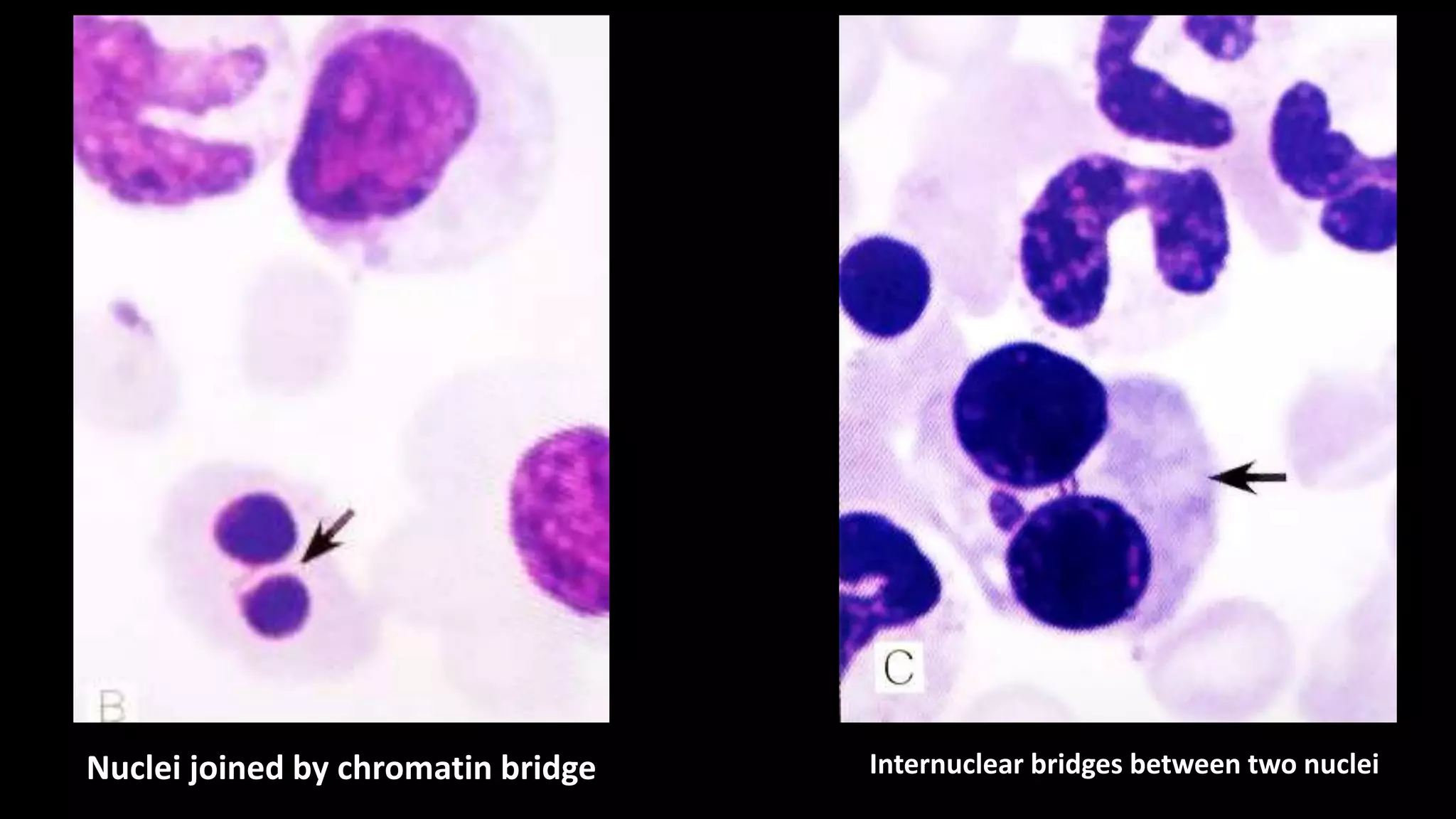 Refreactory anemia | PPTX